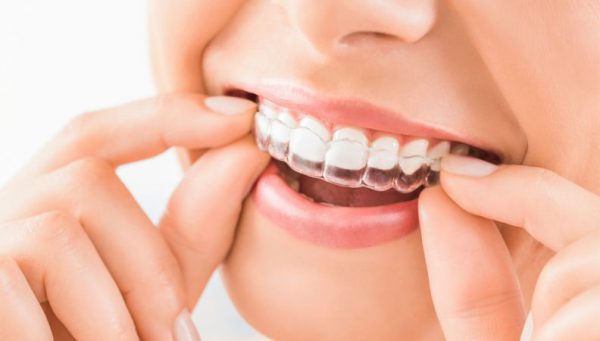 Invisalign – Irvine Dentist